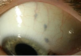 Nederlands Centrum Jeugdgezondheid | 1. Ontwikkeling oog en visuele ...