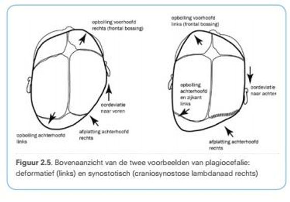 Nederlands Centrum Jeugdgezondheid | Richtlijn: Voorkeurshouding en ...